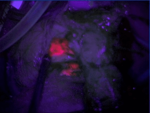 5-ALA Imaging - Dr. Symeon Missios, MD