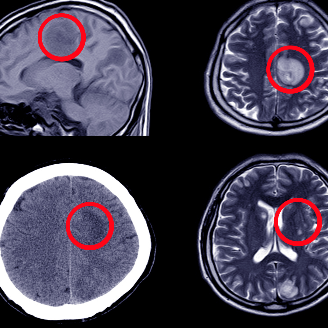 Hydrocephalus Treatment in St James: Hydrocephalus Treatment Hydrocephalus Treatment in St James: Hydrocephalus Treatment