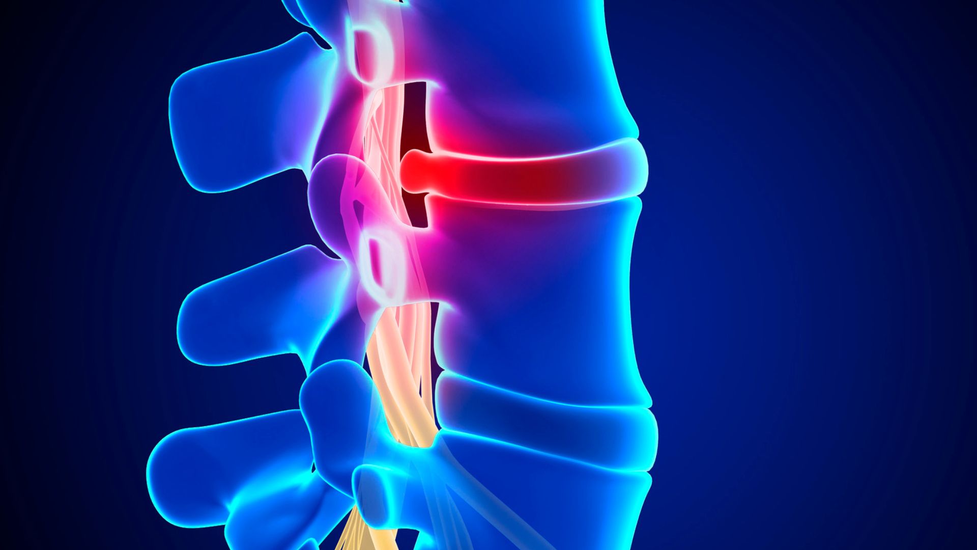Spinal Tumors - Dr. Symeon Missios, MD