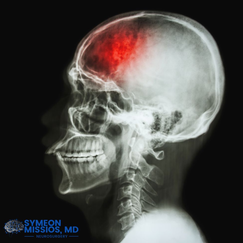 Stroke Doctor in Kings Park | Dr. Symeon Missios, MD